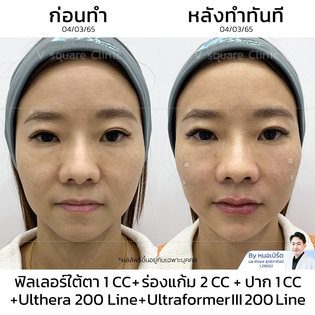 Ulthera ราคาเท่าไหร่ ? อัปเดตโปรโมชั่น 2026 อัลเทอร่า ราคาเกินคุ้ม