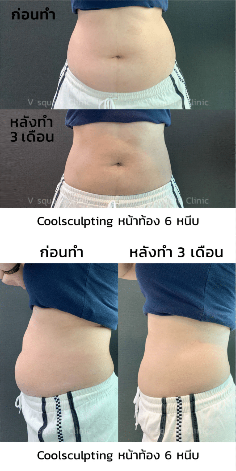 CoolSculpting คืออะไร ทำงานอย่างไร ลดไขมันได้มากแค่ไหน ต้องทำกี่ครั้ง