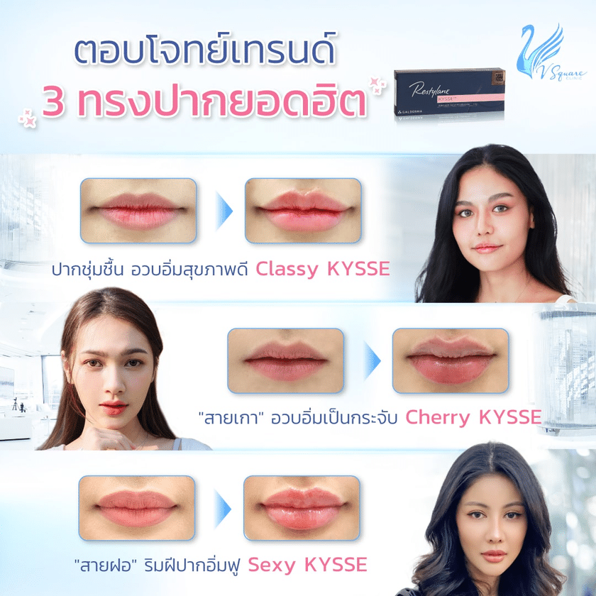 ฟิลเลอร์ Restylane Kysse ทำไมถึงได้รับความนิยม ต่างจากรุ่นอื่นอย่างไร