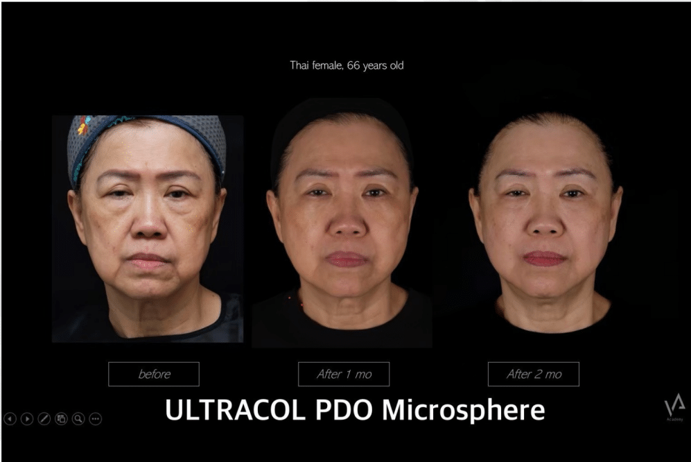 Ultracol ไหมน้ำกระตุ้นคอลลาเจน ตัวช่วยปรับผิวแน่น เพิ่มความกระจ่างใส