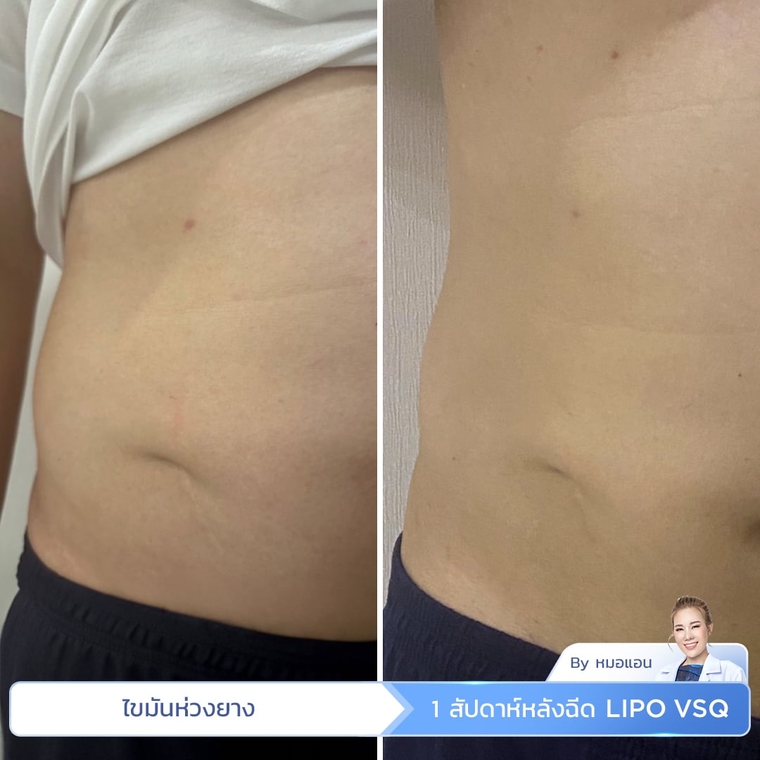 Lipo VSQ คืออะไร ? รีวิว ข้อดี-ข้อเสีย และผลลัพธ์จริงหลังฉีด