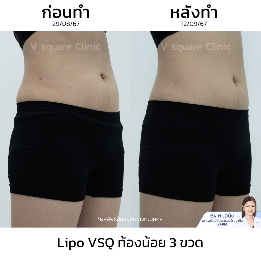 Lipo VSQ คืออะไร ? รีวิว ข้อดี-ข้อเสีย และผลลัพธ์จริงหลังฉีด