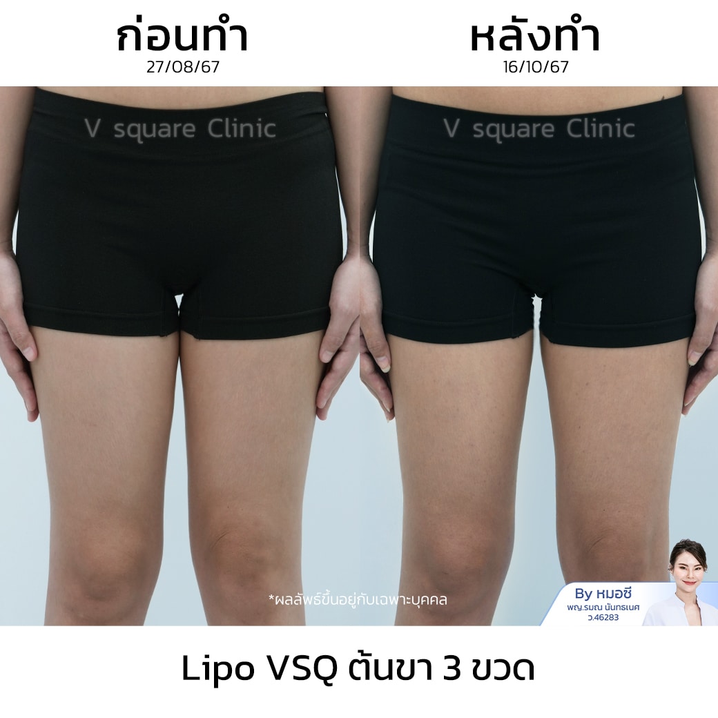 Lipo VSQ คืออะไร ? รีวิว ข้อดี-ข้อเสีย และผลลัพธ์จริงหลังฉีด