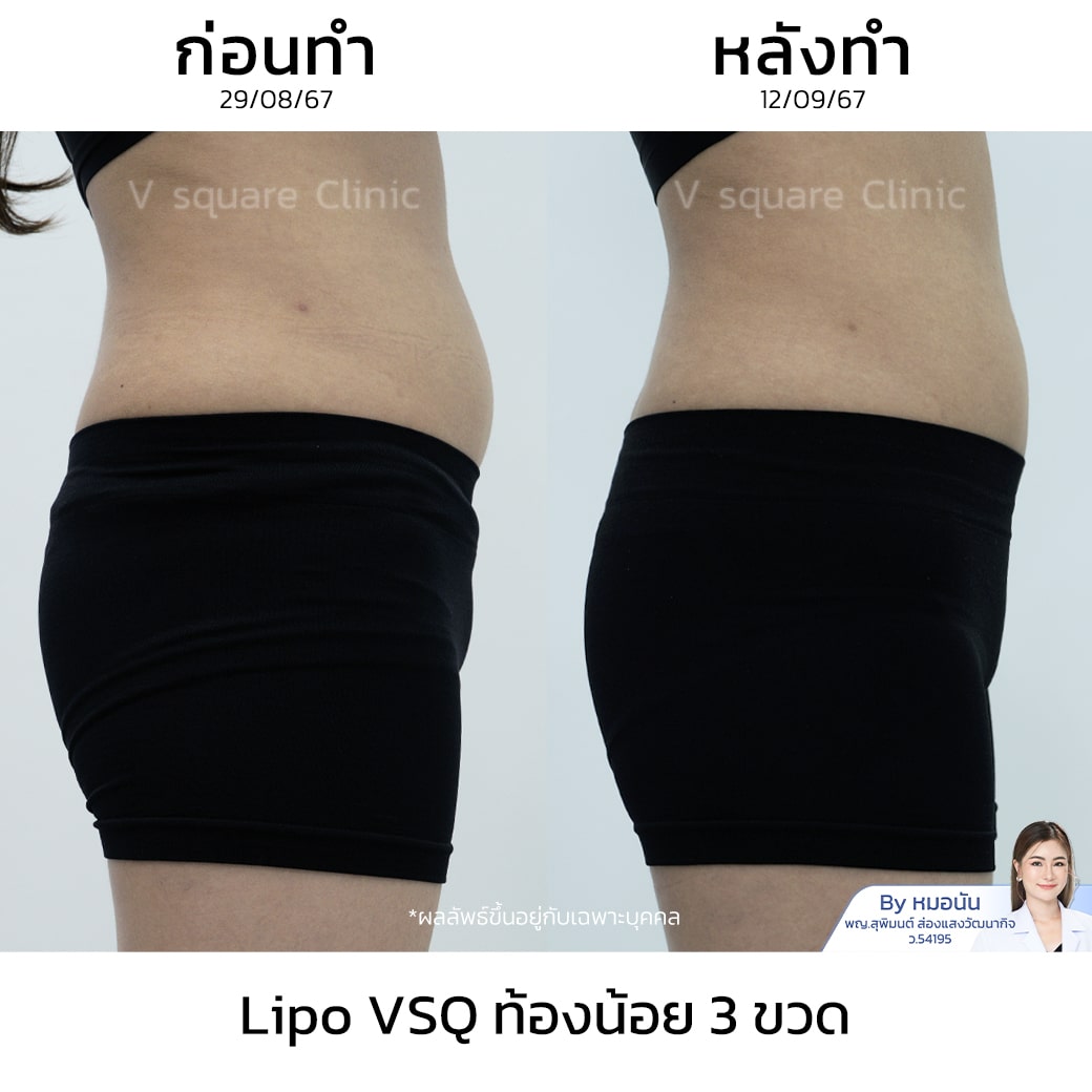 Lipo VSQ คืออะไร ? รีวิว ข้อดี-ข้อเสีย และผลลัพธ์จริงหลังฉีด