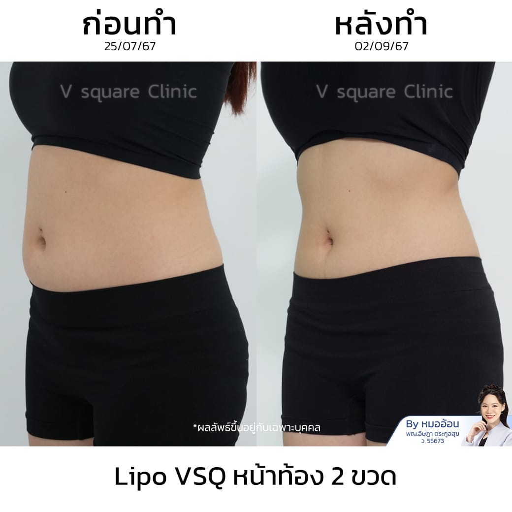 Lipo VSQ คืออะไร ? รีวิว ข้อดี-ข้อเสีย และผลลัพธ์จริงหลังฉีด