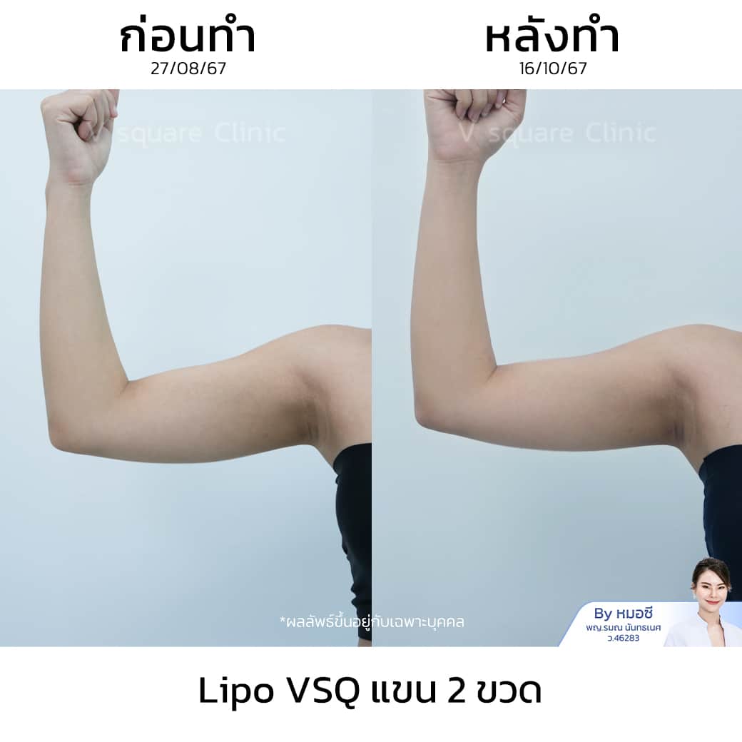 Lipo VSQ คืออะไร ? รีวิว ข้อดี-ข้อเสีย และผลลัพธ์จริงหลังฉีด