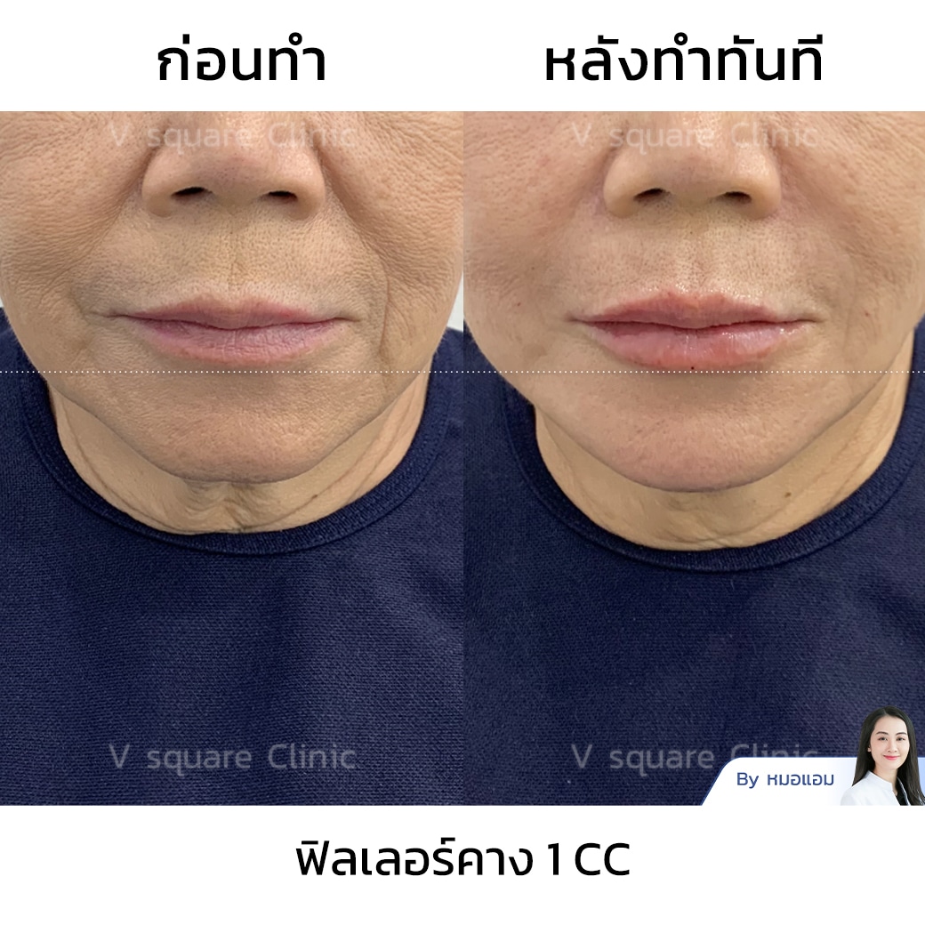 ฟิลเลอร์ 1 CC มีปริมาณเท่าไร ? ใช้เติมเต็มจุดไหนได้บ้าง