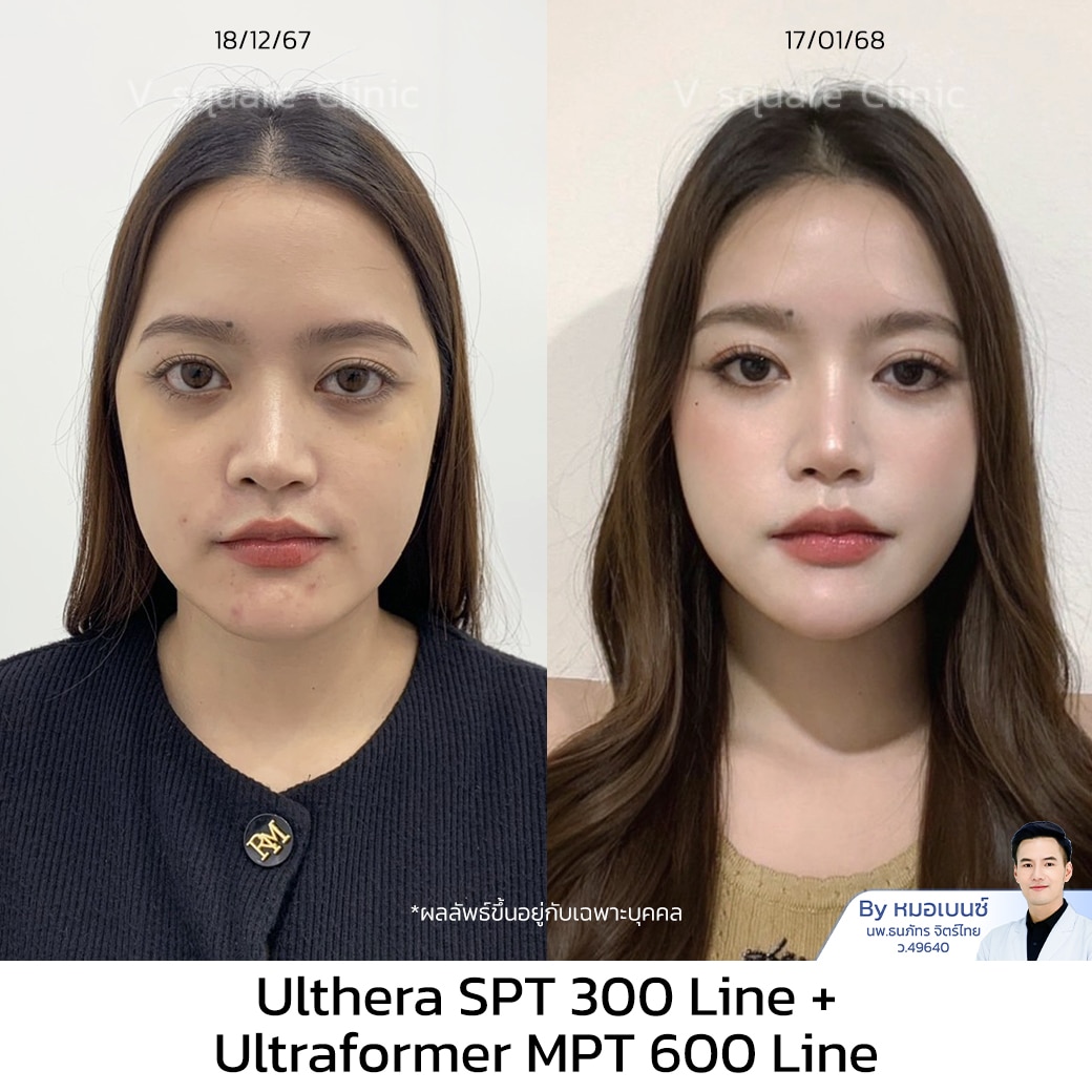 Ultraformer MPT คืออะไร ? รีวิวผลลัพธ์หลังทำ ราคา คุ้มค่าไหม