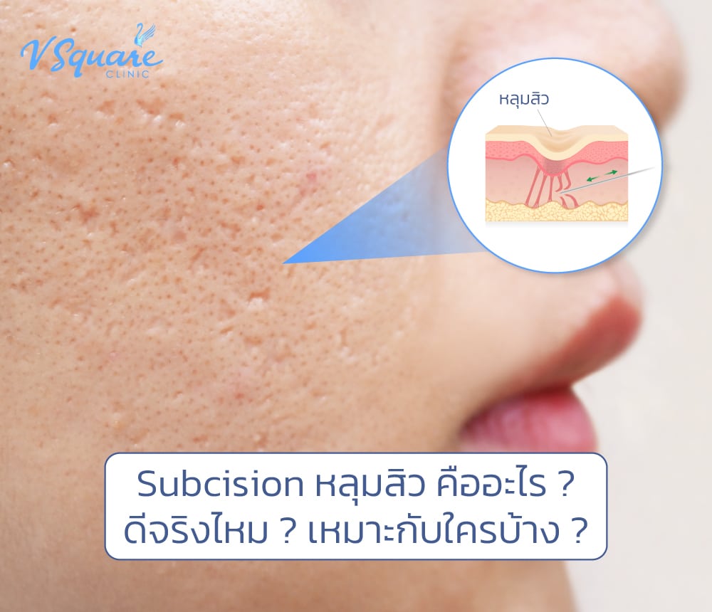 Subcision หลุมสิว คืออะไร เหมาะกับใคร ? รีวิวผลลัพธ์ ราคา